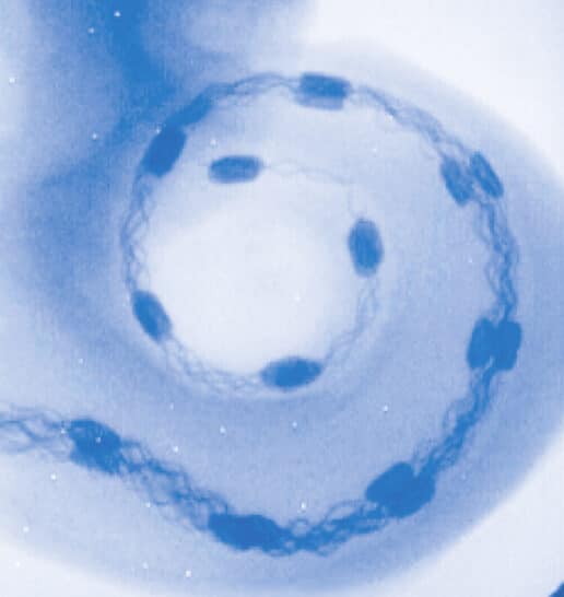 History of Cochlear Implants and MED-EL