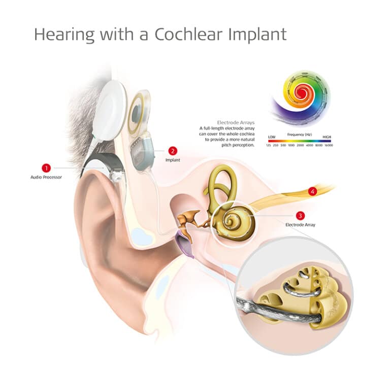 What Is A Cochlear Implant? - The MED-EL Blog