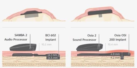 Which Active Bone Conduction Implant: BONEBRIDGE and Osia Compared ...