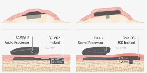 Which Active Bone Conduction Implant: BONEBRIDGE and Osia Compared ...