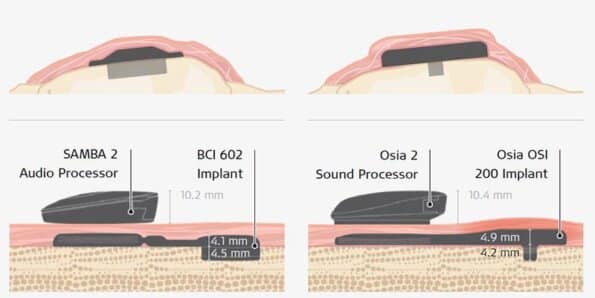 Which Active Bone Conduction Implant: BONEBRIDGE and Osia Compared ...