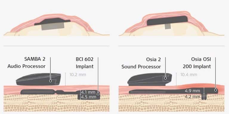 Which Active Bone Conduction Implant: BONEBRIDGE and Osia Compared - The MED-EL Blog