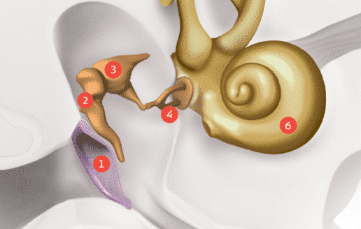Hören mit einem passiven Mittelohrimplantat