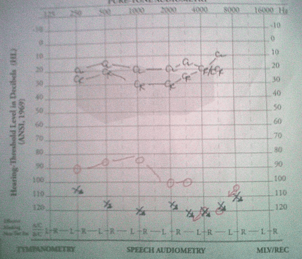 My Cochlear Implant Story: Adam Fitzgerald | The MED-EL Blog