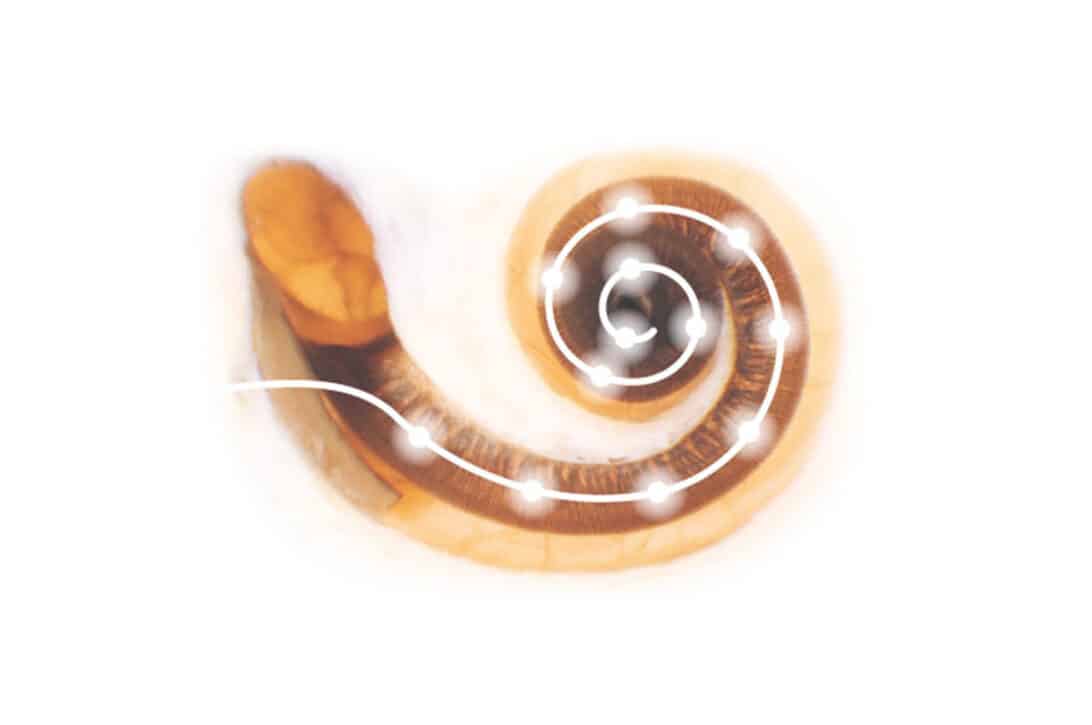 complete cochlear coverage Archives - the MED-EL Blog