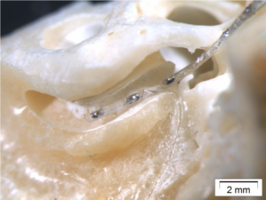 The History of MED-EL Electrode Arrays | The MED-EL Blog